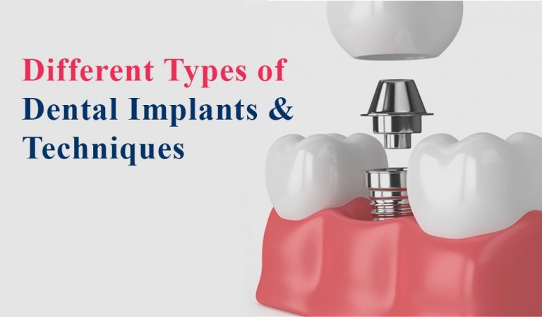 Dental Implants: Types of Implants and Who They're for - Peak Mens Health