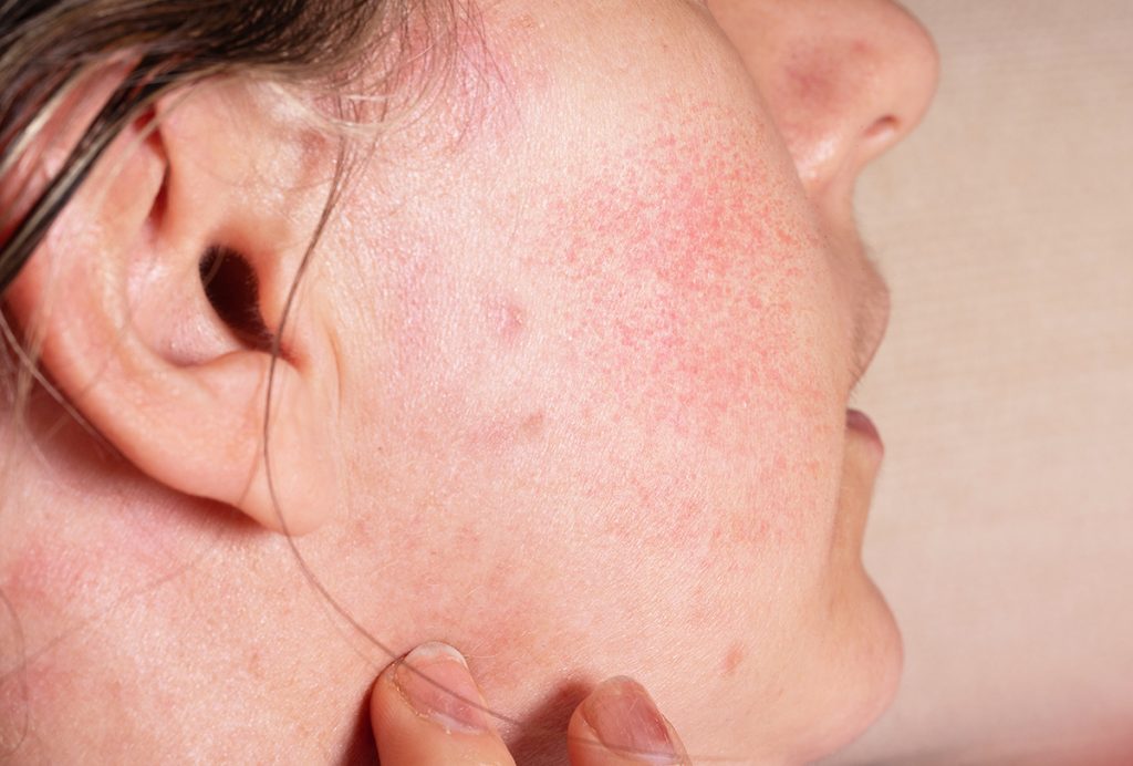 How To Identify and Manage Your Acne Rosacea Safely & Effectively ...