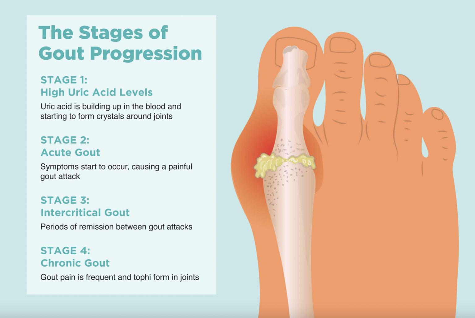 Gout – Cause, Symptoms, and Treatment - Peak Mens Health